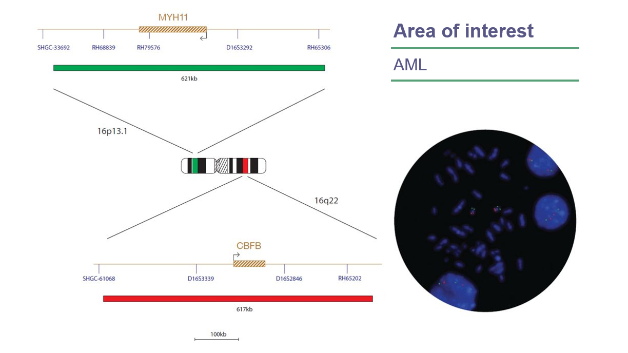 CytoCell FDA-cleared FISH probes for AML & MDS | OGT